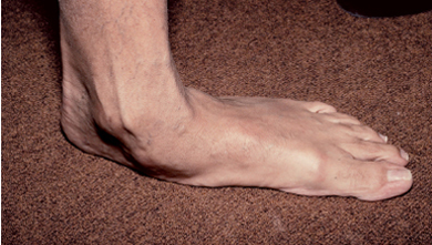 Piciorul plat la adult- actualitati in managementul terapeutic